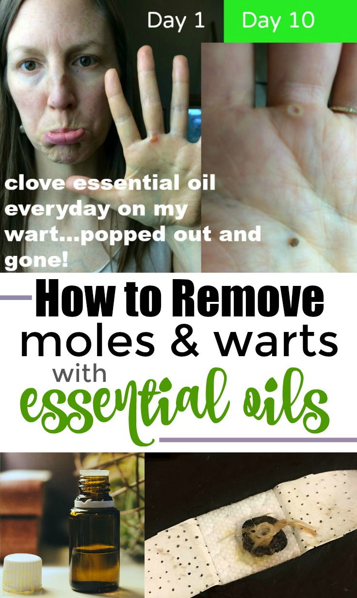 How to Remove Moles and Warts with Essential Oils - Eat Beautiful